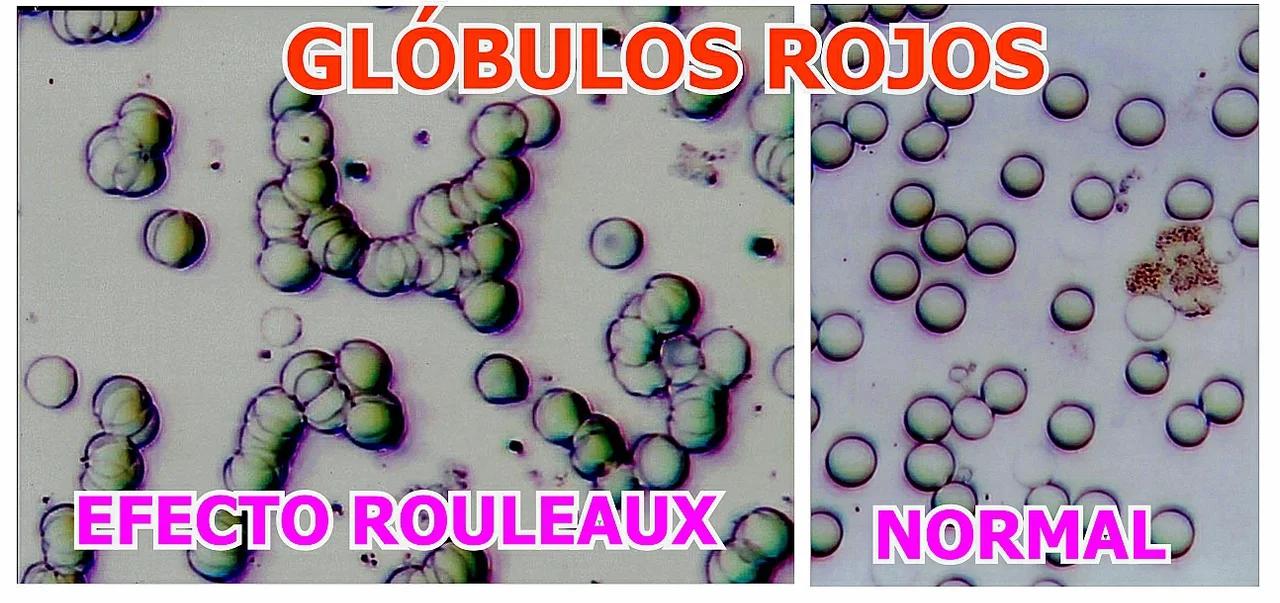 FENÓMENO ROULEAUX - Dr. Wilfredo Stokes