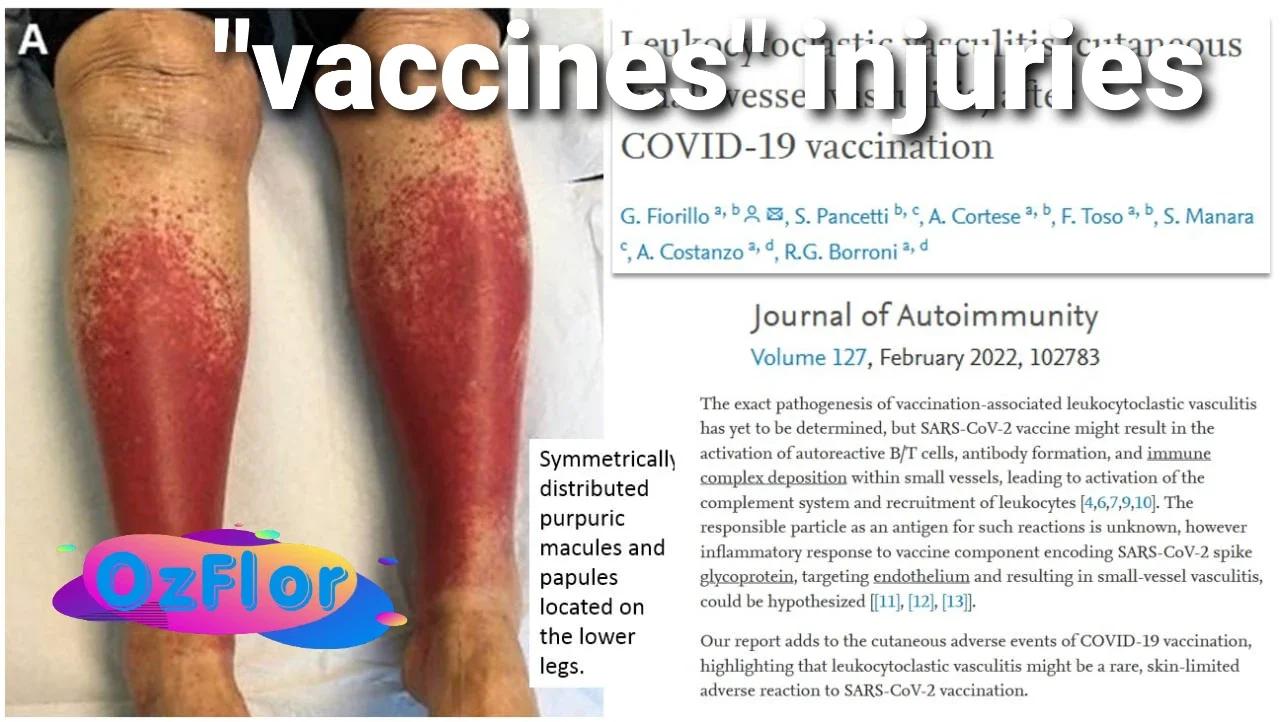 Leukocytoclastic vasculitis (cutaneous small-vessel vasculitis) after # ...