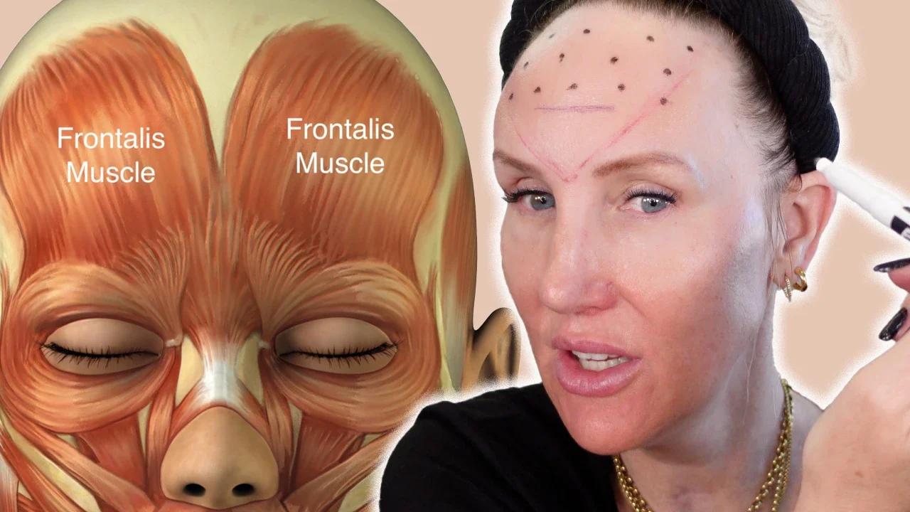 Forehead Tox - Don't make these mistakes! >> Frontalis Tox Treatment