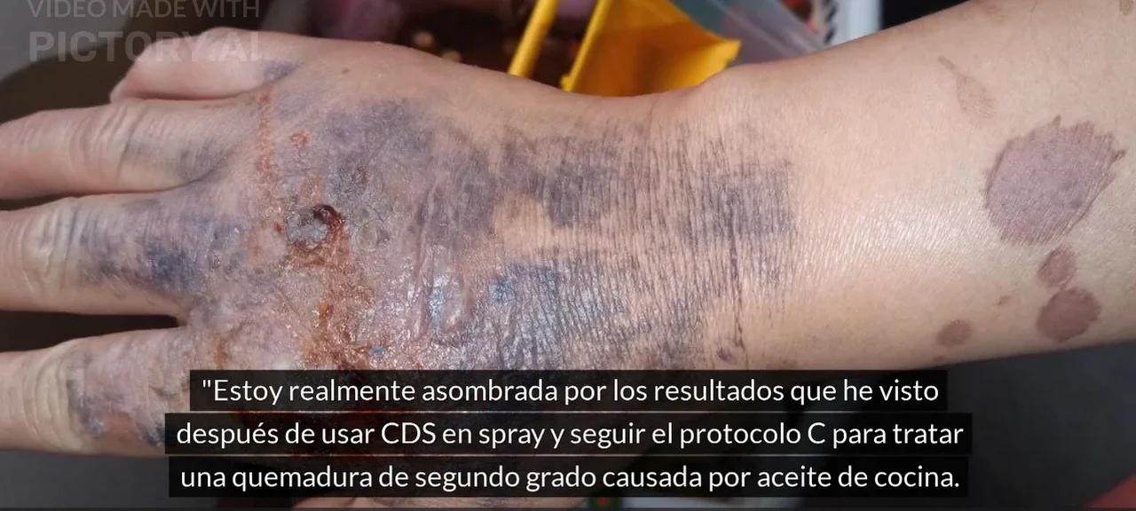 quemadura de segundo grado curada con CDS en spray y protocolo C!