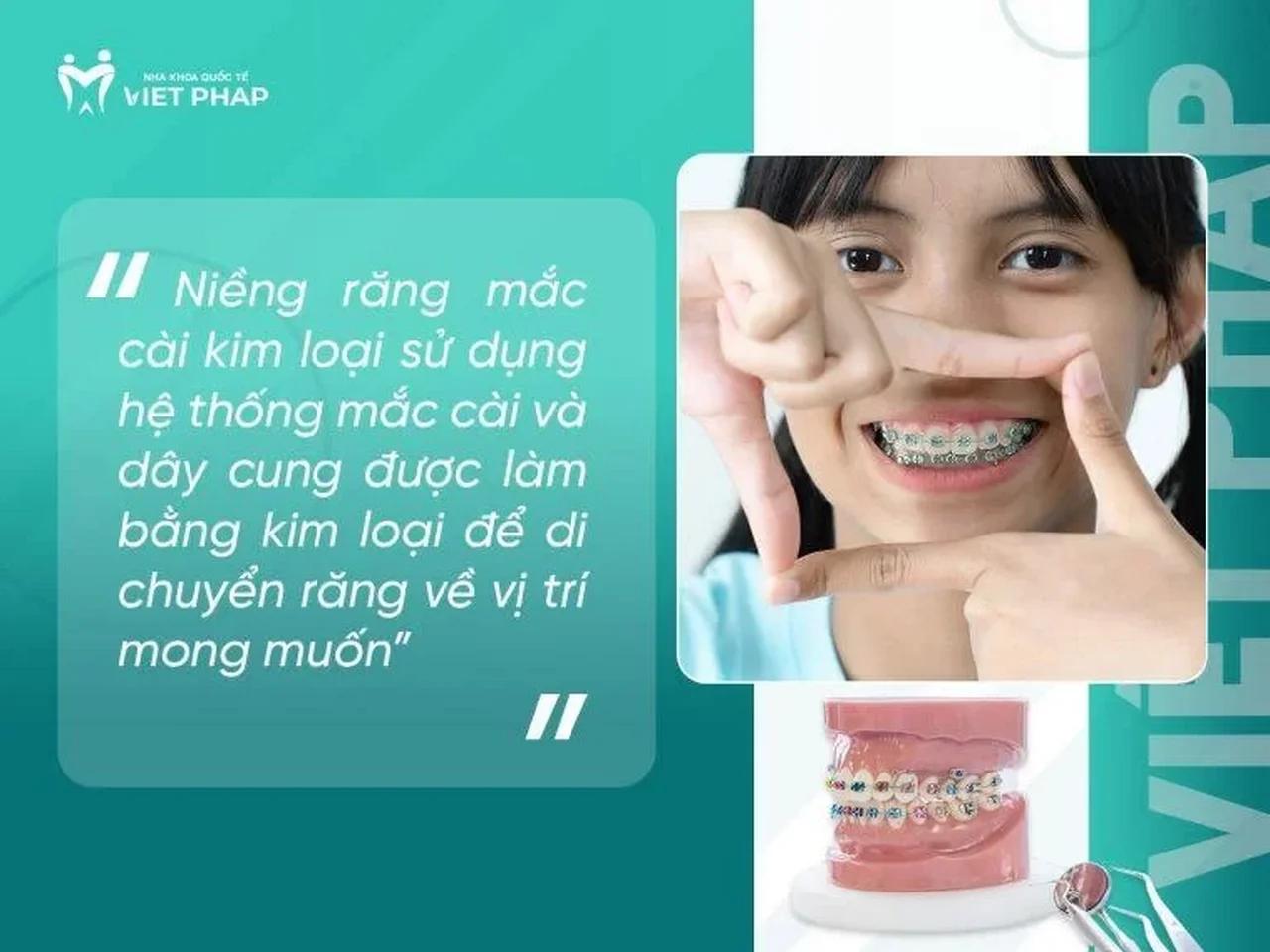 4 loại niềng răng được lựa chọn nhiều nhất hiện nay