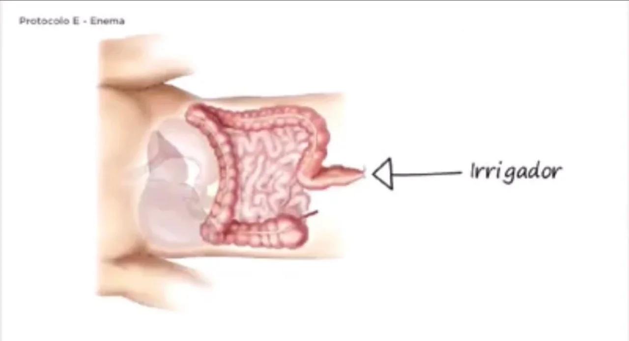 Protocolo E Enema