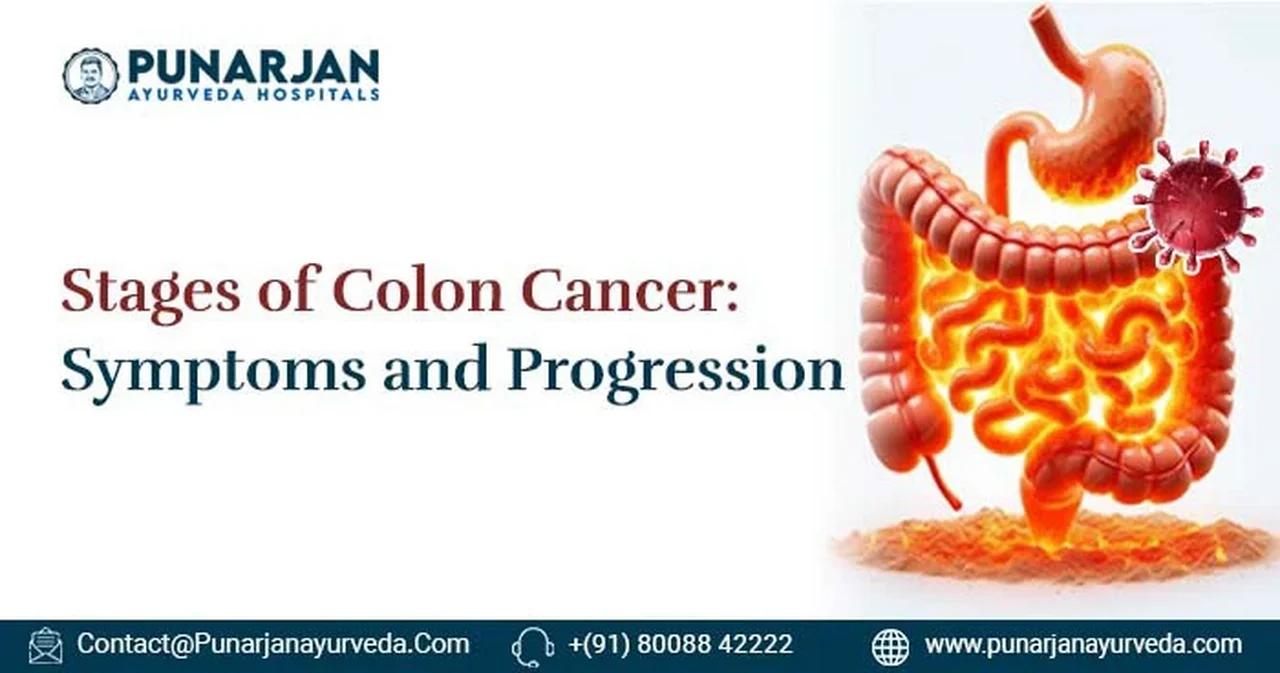 Stages Of Colon Cancer: Symptoms And Progression