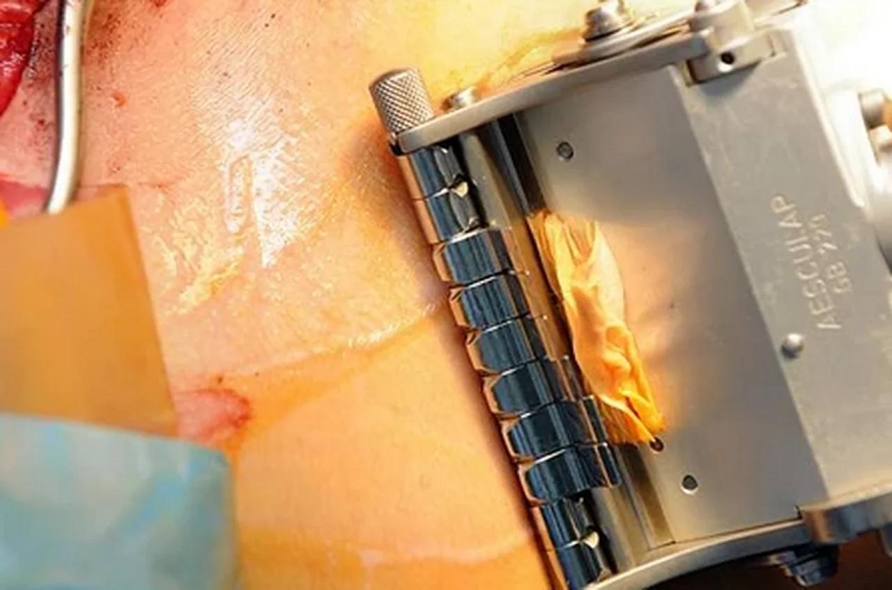 Male to Female Transgender Operation Vaginoplasty