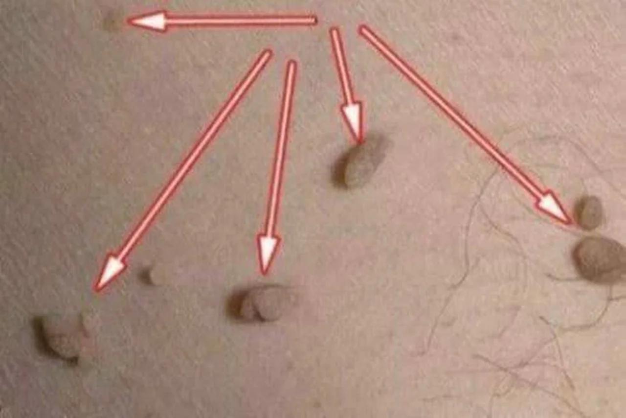 IF PAPILLOMAS APPEAR ON THE NECK OR CHEST, THE PARASITES ARE ALREADY ...